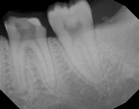 Glide Path Revisited Are Hand Files Needed In Modern Endodontic Treatment Oral Health Group