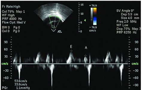 Mitral Valve Doppler Flow With E And A Wave Download Scientific Diagram