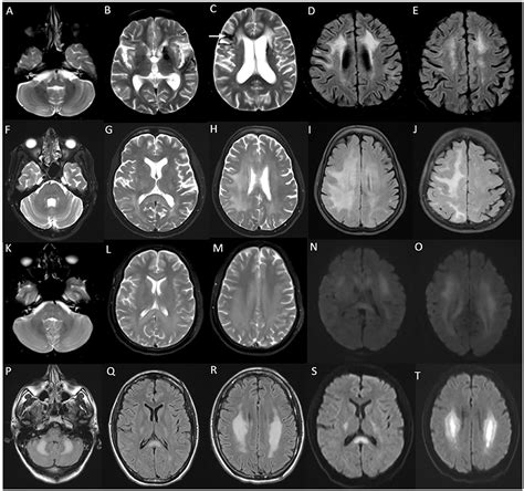 Frontiers Adult Onset Leukodystrophies A Practical Guide Recent