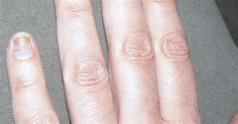 What Do Chemo Nails Look Like At Angela Bates Blog