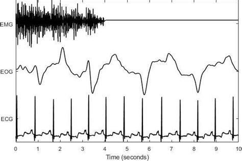 Three Kinds Of Artifacts Emg Eog And Ecg Download Scientific Diagram