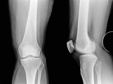Radiografía de la rodilla vistas lateral y posterior