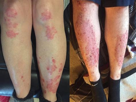 Psoriasis On Legs Causes Symptoms And Treatment Psoriasis Expert