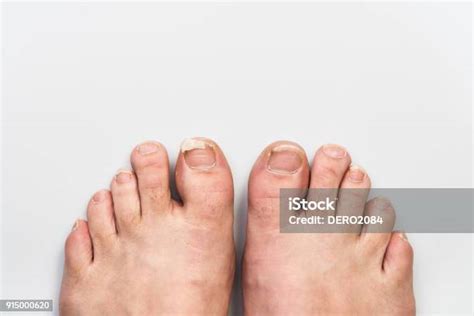 다리 더러운 포경 및 깨진 손톱 평면도 회색 배경 건강 관리에 버려진된 손가락 건강관리와 의술에 대한 스톡 사진 및 기타 이미지