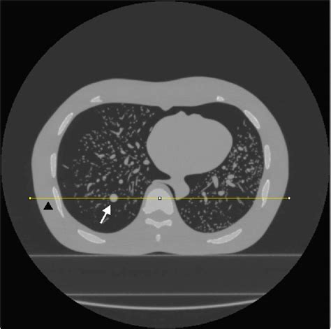 Placement Of The Roi In The Ct Image To Measure Ct Number Profiles Ct