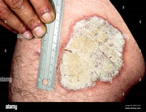 Ostraceous Psoriasis Patch Of Scaly Psoriatic Skin On A Mans Upper
