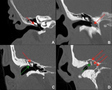 Prussak Space Ct Scan