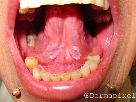 Lesion En La Lengua Blanca Flash Sales Br