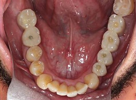 Clinical Aspects At The Time Of Immediate Loading Frontal View In