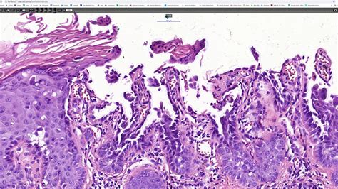 Acantholytic Acanthoma Phillip Mckee Antonina Kalmykova Csd Health