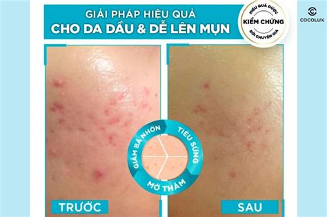 Review Tinh Chất Garnier Bright Complete Anti Acne Booster Serum