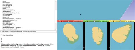 Combining Segmentation Hierarchies Support 3d Slicer Community