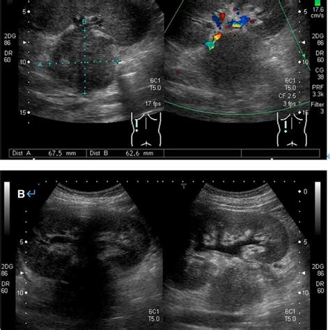 A B Renal Ultrasonography A Heterogeneous Mass 675 × 626 Cm