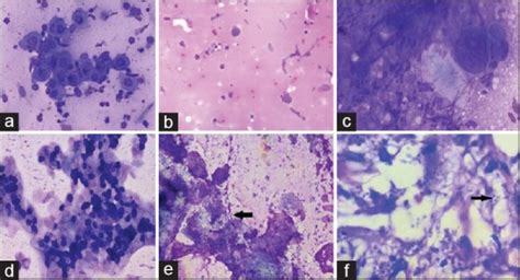 Acantholytic Cells