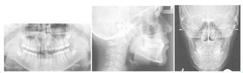 Pretreatment Panoramic Radiograph And Lateral And Frontal Cephalometric