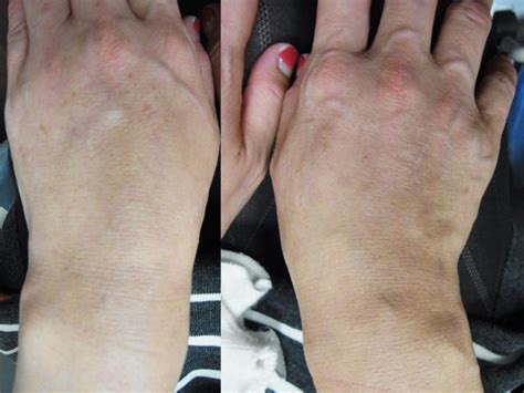 50代女性 両腕、両手甲と前腕の浮き出た血管を目立たなくした治療例 ハンドベイン治療サイト｜北青山dクリニック