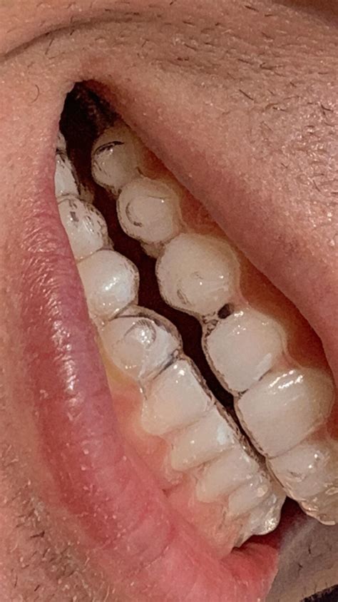 Rotated Tooth Not Tracking When To Advise Ortho Rinvisalign