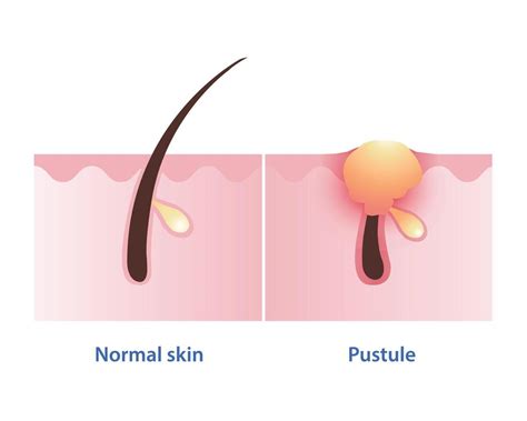 Skin Pustule