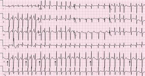 Ecg Ekg Examples And Quiz Oxford Medical Education