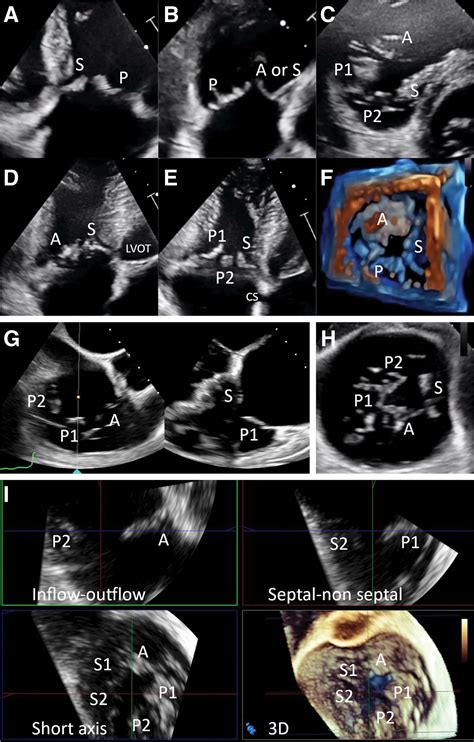 The Tricuspid Valve A Review Of Pathology Imaging And Current
