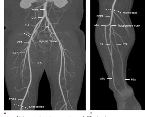 Pdf Doppler Ultrasonography Of The Lower Extremity Arteries Anatomy And Scanning