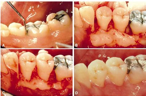 Eliminated The Interproximal Osseous Defects By Ramping To