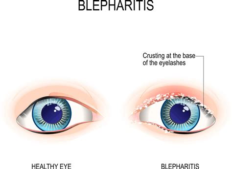 Difference Between Dry Eyes Blepharitis And Mgd Get Solutions Dry
