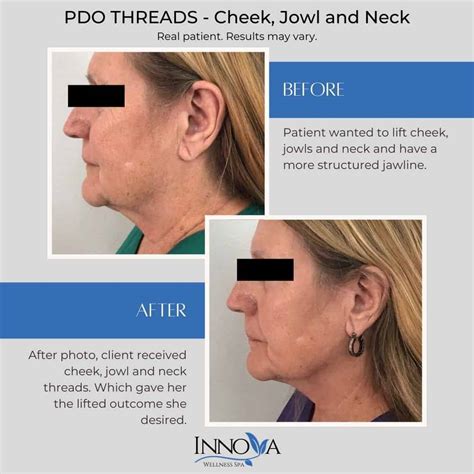 Pdo Threading Innova Wellness Spa Ocala Fl