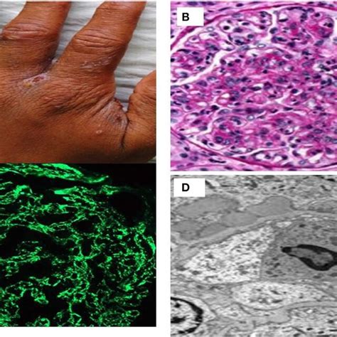 A A Case Of Streptococcus Infected Scabies Lesion In Interdigital Web