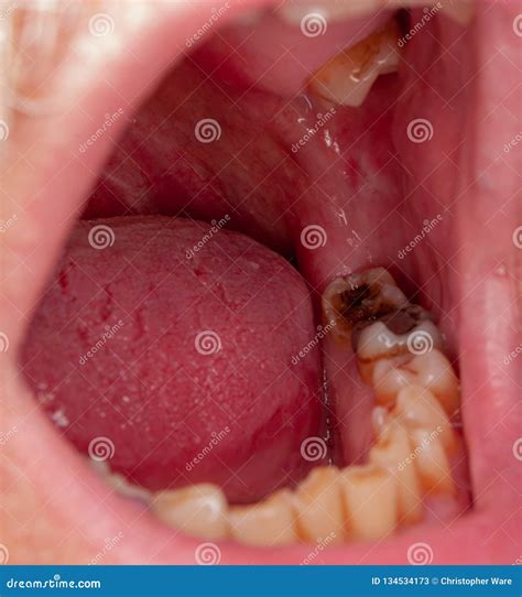 Tooth Decay Stock Image Image Of Caries Tooth Teeth 134534173