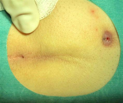 Detailed Information About Pilonidal Cyst Sinus Pilonidalis Zentrum