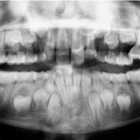 Pdf Treatment Of Ectopic First Permanent Molar Teeth