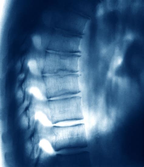 Scheuermanns Disease Radsource Scheuermanns Disease Dysostosis Of