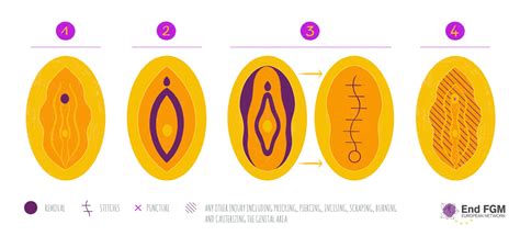 Type 2 Female Circumcision