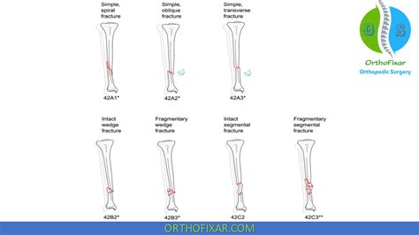 Tibia Fractures Orthofixar 2025