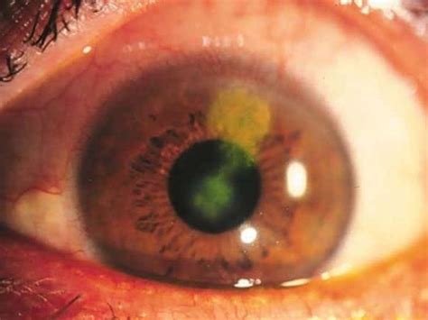 Stressed And Branching Out Litfl Ophthalmology Befuddler