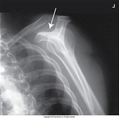 Supraspinatus Outlet Tangential Projection Shoulder Joint Neer Method Diagram Quizlet
