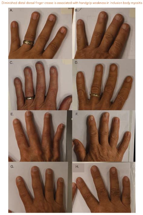 Diminished Dorsal Finger Creases In Myositis Patients European