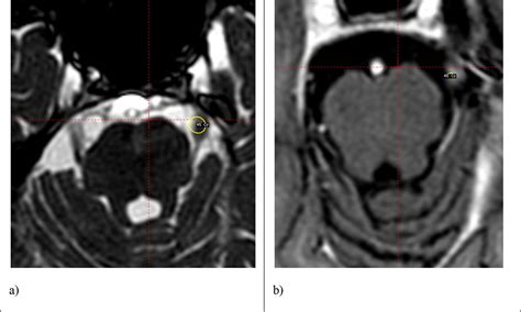 Role Of Gamma Knife Radiosurgery In Trigeminal Neuralgia Its Long Term Outcome And Prediction