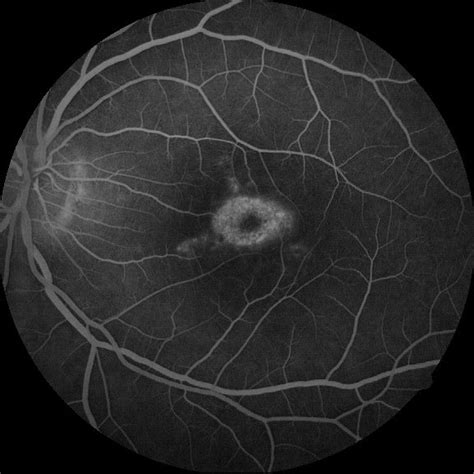 Pdf Oct In Progressive Cones Dystrophy