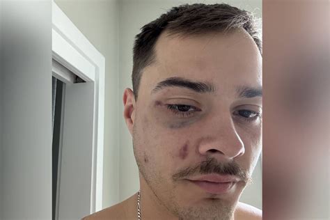 Dc Man Says He Was Beaten Up After Kissing Partner At Dupont Circle