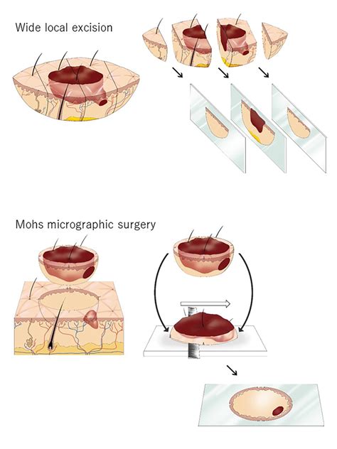 Barriers To Mohs Micrographic Surgery In Japanese Patients With Basal