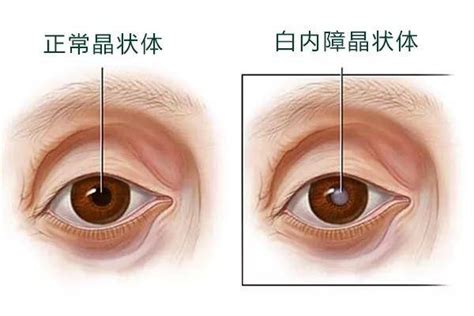 科普 听说白内障做了会复发 搜狐大视野 搜狐新闻