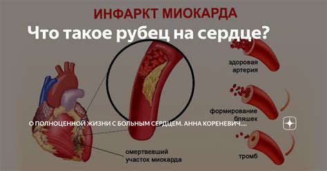 Что такое рубец на сердце? | Анна Кореневич | Врач-кардиолог ...