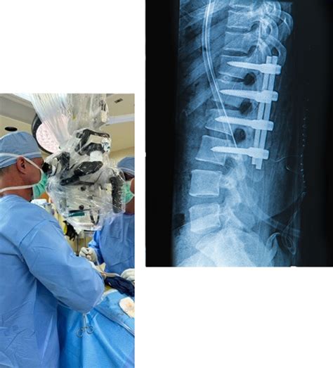 Spinal Implants And Design K Brandon Strenge Md