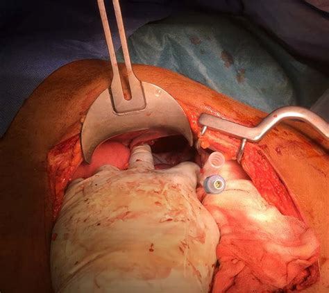 Defect Of The Left Hemidiaphragm Download Scientific Diagram