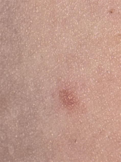 Could This Be A Bite R Scabies