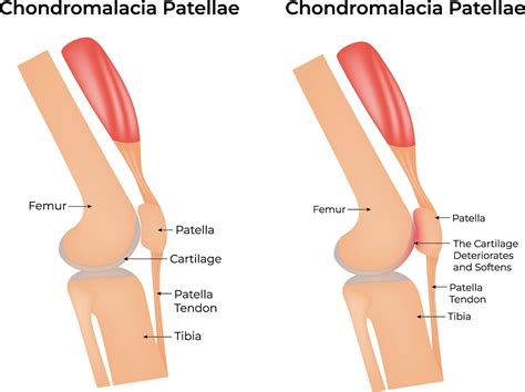 B5chondromalacia Patellae Medical Illustration Knee Joint Anatomy