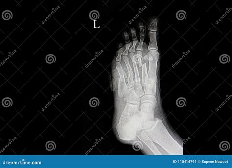 Fractured Metatarsal Bones Stock Image Image Of Bone 115414791