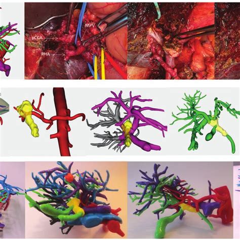 Bismuth Iv Type Perihilar Cholangiocarcinoma With Right And Left Portal Download Scientific
